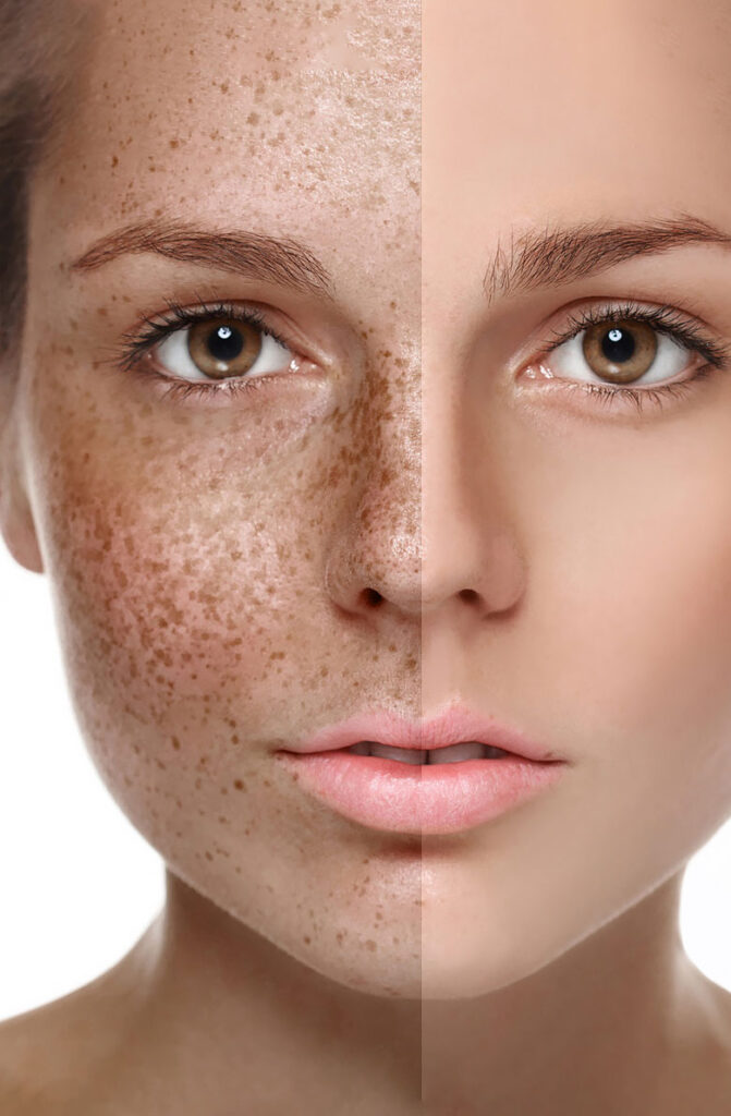 Laser correction of hyperpigmentation | Holy Land Cosmetics